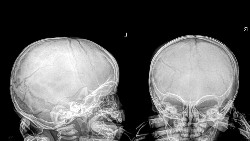 Traumatic Brain Injuries - Sage Brain & Spine